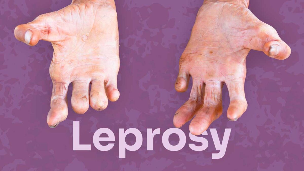 Leprosy: What do we know about it? - Buzzer